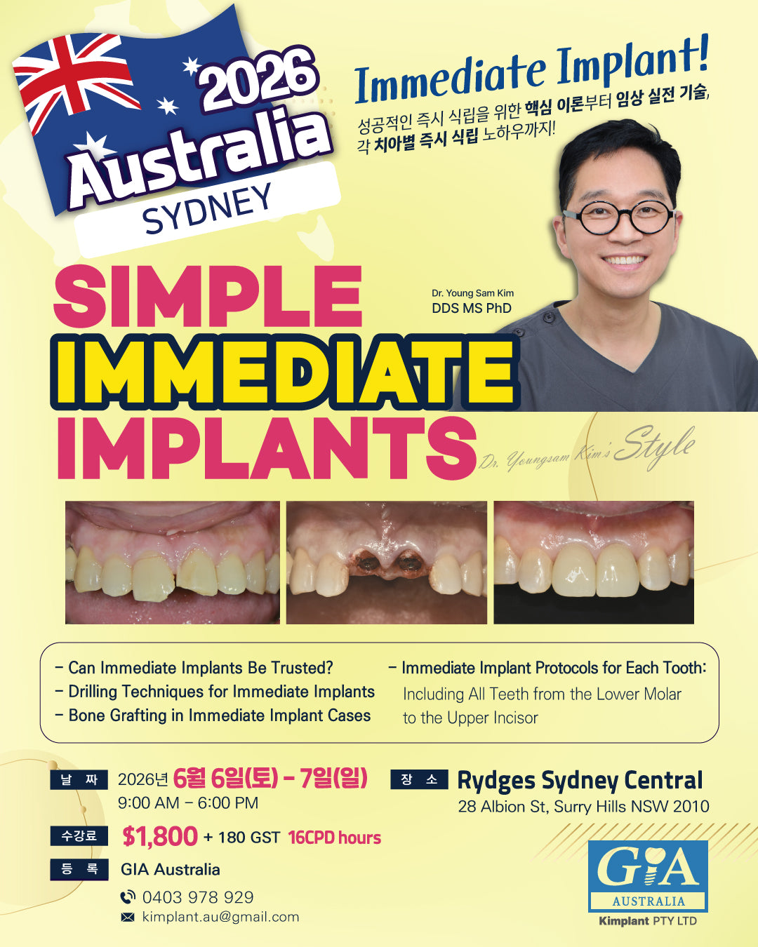 Sydney, Australia) Simple Immediate Implants [2026/6/6 ~ 6/7] – GIA USA